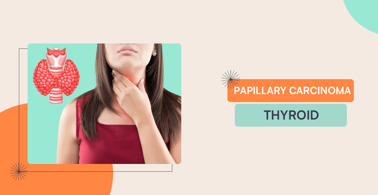 Papillary Carcinoma Thyroid: Causes, Symptoms, And Treatment